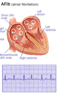 Atrial Fibrillation - INR Online NZ